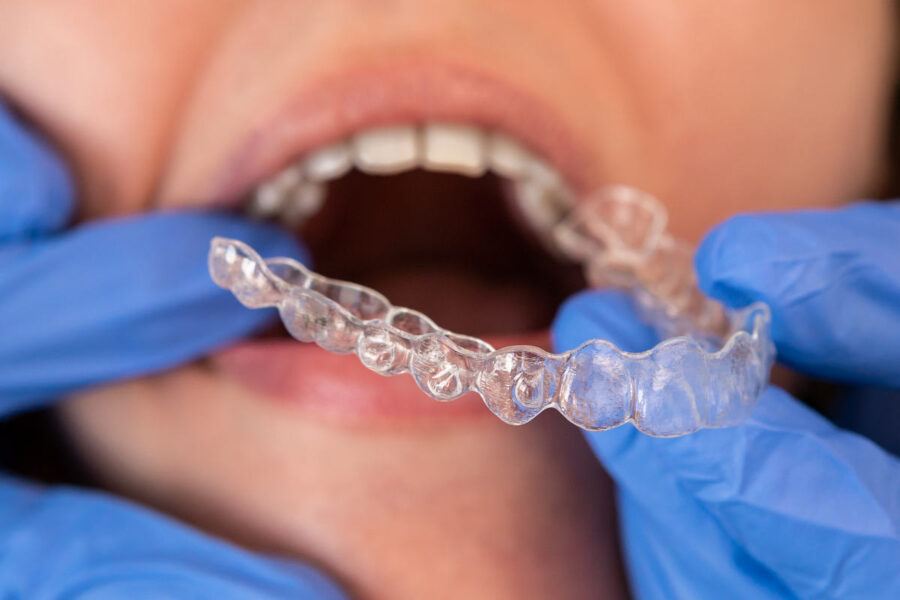 Clear Braces - Dr. David Monaghan